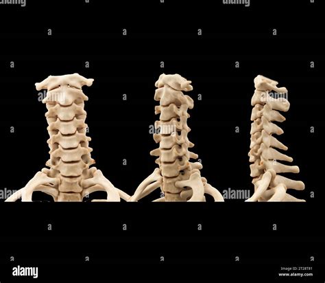 Ct Scan Of C Spine Or Cervical Spine 3d Rendering For Diagnosis Fracture Of Cervical Spine In