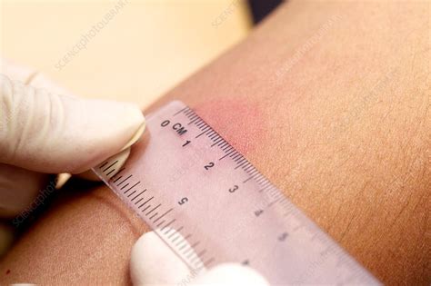 Tuberculosis Testing Stock Image C014 1839 Science Photo Library