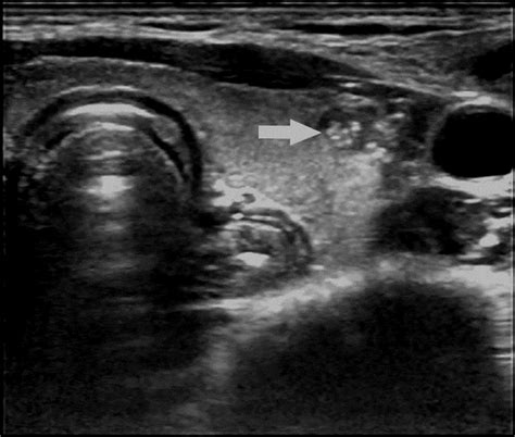 A Papillary Thyroid Carcinoma With Multiple Punctate Echogenic Foci Download Scientific Diagram
