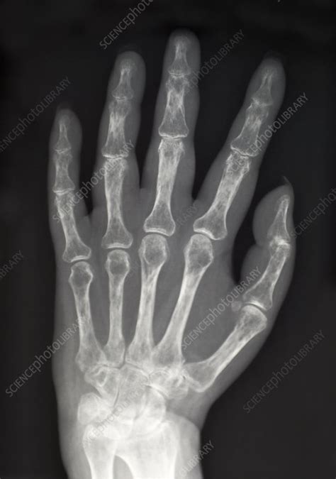 Osteoporosis X Ray Vs Normal Dual Energy X Ray Absorptiometry Dxa Of