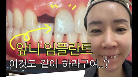 앞니 임플란트 마지막 치료 고난의 연속 임플란트는 왜 임시치아가 없나욧 Youtube
