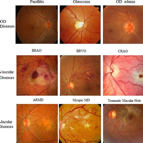 Fundus Image Of Eye Hard Exudates Can Be Seen Download Scientific Diagram