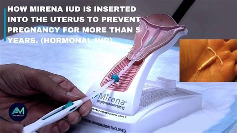 Does The Mirena Coil Contain Estrogen
