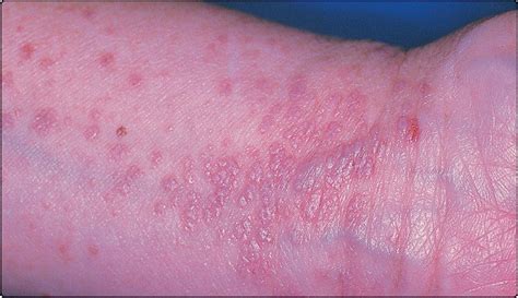 Lichenoid Eruptions Clinical Tree