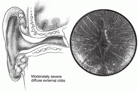 Diffuse Otitis Externa