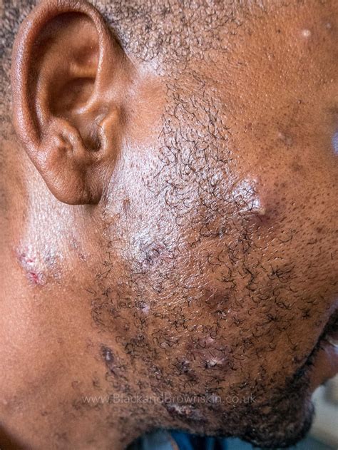 Sycosis Barbae — Black And Brown Skin