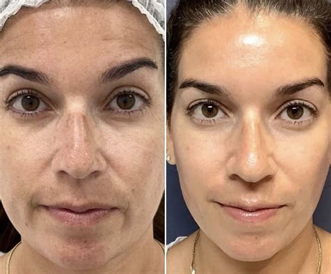 Clear And Brilliant Laser Miami Beach Clear Brilliant