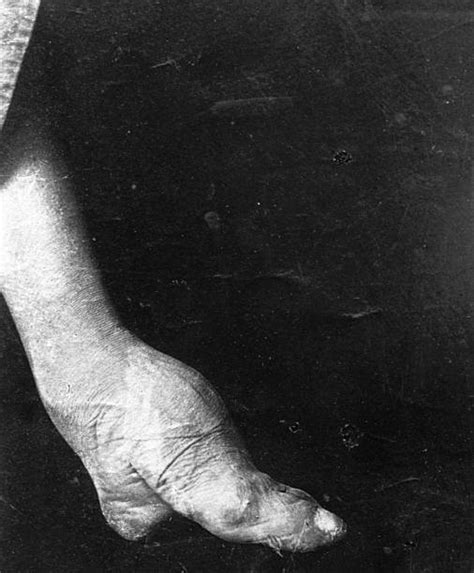 foot binding x ray