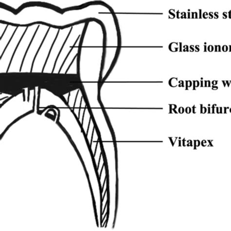Schematic Diagram Of A Primary Molar In The Mta Group Download