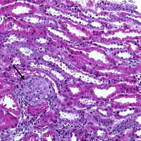 Renal Biopsy Sample B Noncaseating Granuloma Arrow In The
