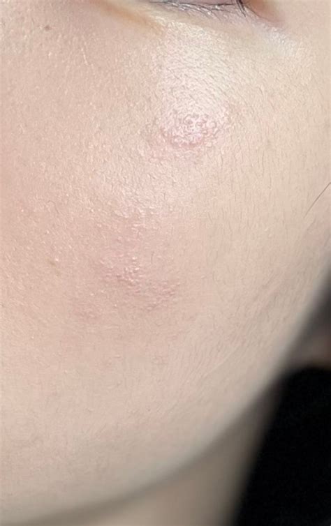 아토피 스테로이드 연고 부작용 지식in