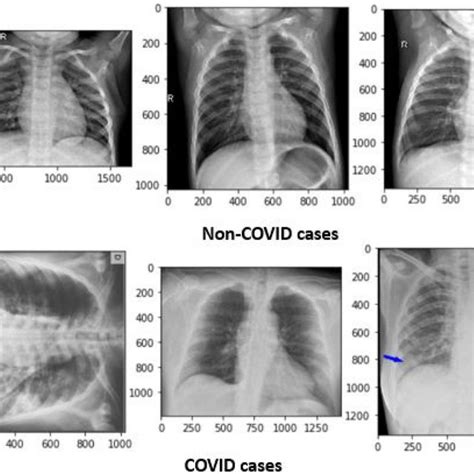 Sample Of X Ray Images COVID And Non COVID Cases Download Scientific Diagram