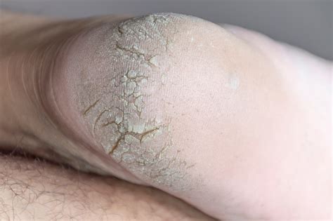 금이 간 발 뒤꿈치를 더 깊은 균열과 건조한 벗겨진 피부를 닫습니다 거친에 대한 스톡 사진 및 기타 이미지 거친 건강관리와 의술 건강하지 못한 생활방식 Istock