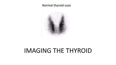 Solitary Thyroid Nodule Pptx