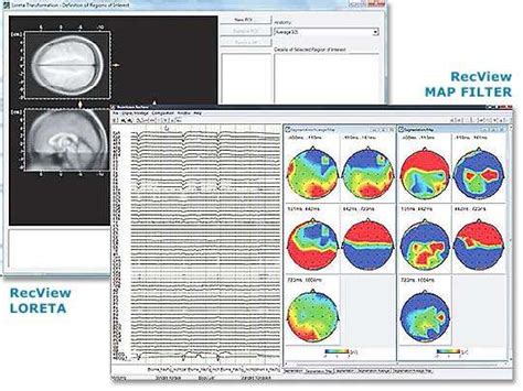 Quantitative Eeg Brain Mapping