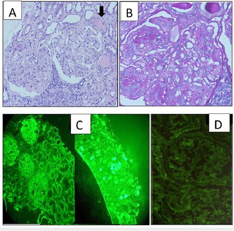 Photomicrographs Of A Case With Mixed Lesions Lccn With Midd A Download Scientific Diagram