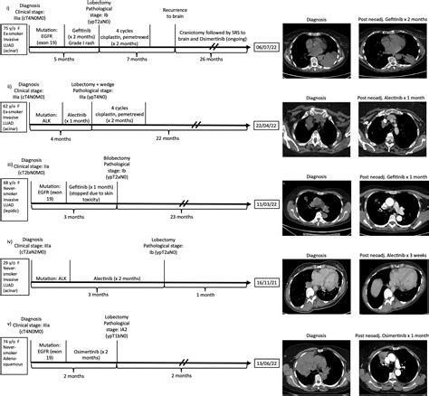 Neoadjuvant Targeted Therapy In Non Small Cell Lung Cancer And Its Impact On Surgical Outcomes