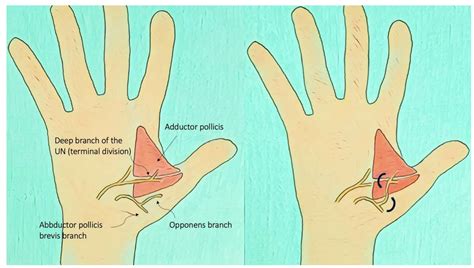 Adductor Pollicis Atrophy