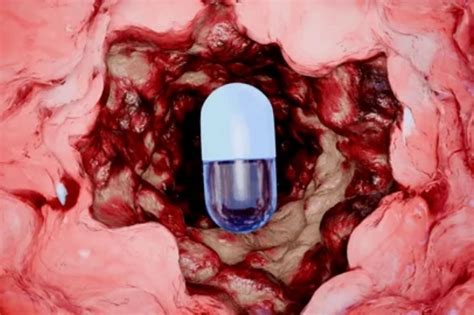 Rectal Polyp Dr Rajendras Pilex Clinic