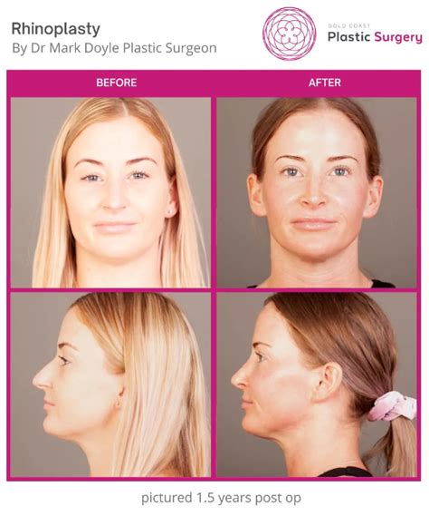 Rhinoplasty Recovery Au