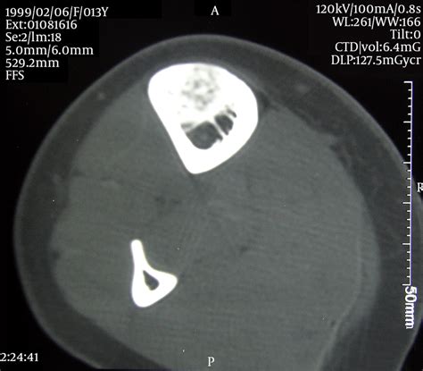 Axial Cut Of Ct Scan Of Adamantinoma Of Tibia Download Scientific Diagram