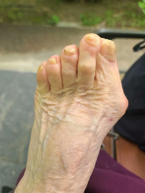 2024422 엄마의 세월이 담긴 휘어진 손과 발 아산병원 정원에서 손톱 발톱 정리 Youtube