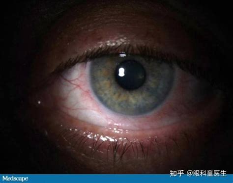 青光眼睫状体炎综合征 知乎