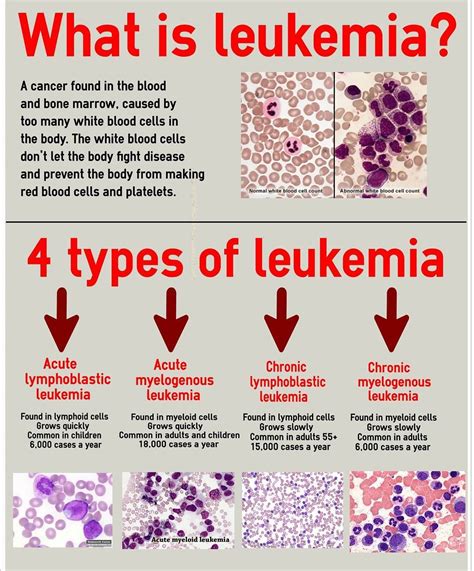 Leukemia Types In Adults Hot Sex Picture