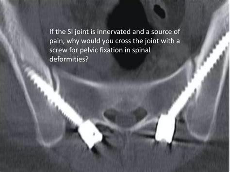 Sacroiliac Joint Fusion Ppt