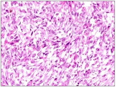 Bcor Overexpression In Pediatric Sarcomas A Morphologic Continuum Of