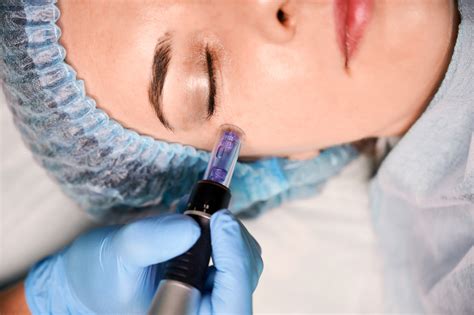 The Powerful Radiofrequency Microneedling Thrive Aesthetics