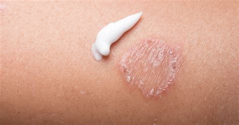 From Incision To Recovery What To Expect With Cellulitis Surgery By Prasanthvs Medium