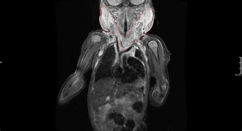 Magnetic Resonance Imaging Short T1 Inversion Recovery Stir Sequence Download Scientific
