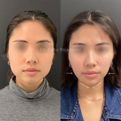 Tips For Getting A V Shaped Or V Line Face Naturally Without Surgery Or Injections Usha