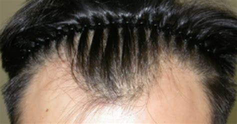 대머리 모발이식으로 자신감 회복을