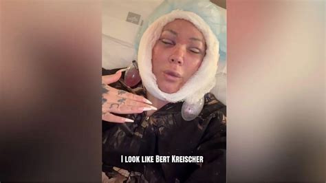 Bunnie Xo Reveals Graphic Before And After Following A Facelift