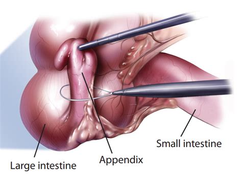 Appendix Appendix Removal Does It Really Increase Your Risk Of