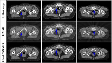 visual comparison between the mar results of rl arcnn and li method