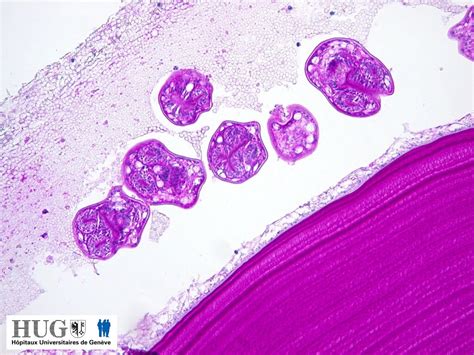 Echinococcosis Human Pathology