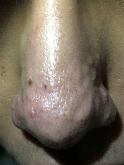 What Type Of Nose Scars Treatment Several Pictures Acne Scars Acne Org Forum