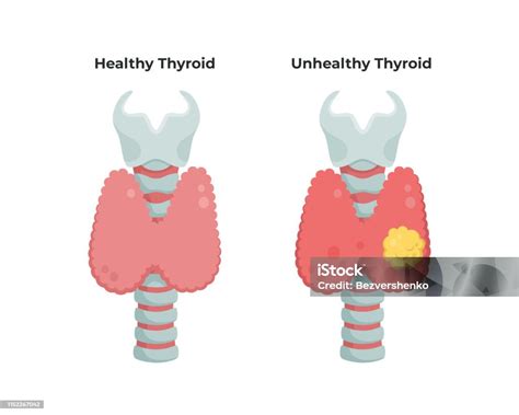 건강 한 갑 상선과 유해한 갑 상선 염증 및 덩어리 갑 상선 암 개념 흰색 배경에 고립 된 평면 그림 의료 인포 그래픽 요소입니다 갑상샘에 대한 스톡 벡터 아트 및 기타