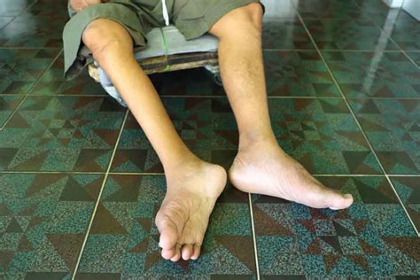 Polio Symptoms 14 Early Warning Signs Of Polio Types And Causes