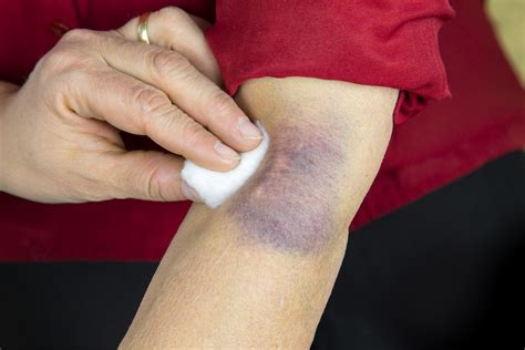 Conoce Los Diferentes Tipos De Hematomas Y Cómo Tratarlos Mibtr