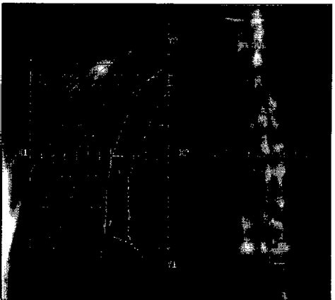 Figure 2 From Treatment Of Malignant Pleural Mesothelioma With A Conformal Dynamic Arc