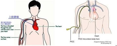 Picc 並發濕疹能塗藥膏嗎？個體化維護 細節決定成敗 壹讀