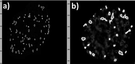 Illustration Of Differences In Counting Of γh2ax Foci Per Htb140 Cell