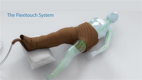 Treating Lymphedema The Flexitouch System Lymphedema Pump Youtube