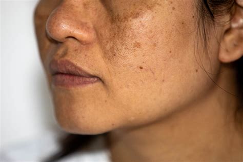 Hypopigmentation Versus Hyperpigmentation Victorian Dermal Group