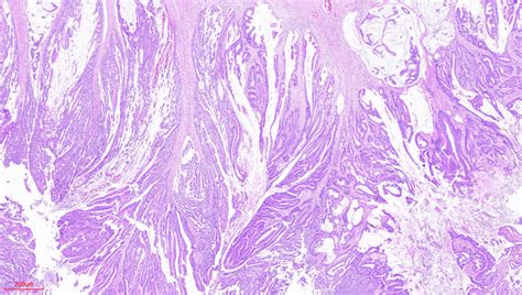 Colorectal Tumour Tissue Microarray Mymab Biologics