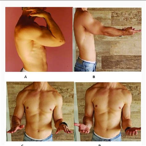 Postoperative Pictures Taken Months After Surgery Showing Bilateral Download Scientific